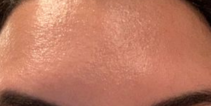 How to Prevent Congested Skin? How to Prevent Congested Skin?